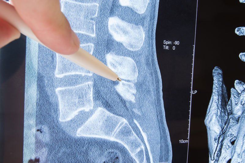 Everything You Need to Know About Spinal Stenosis